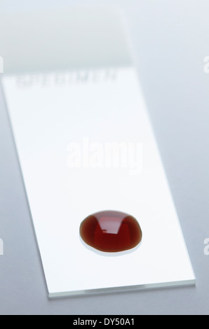 Blood sample on microscope slide. Researcher Analyzing Microscope Slide ...