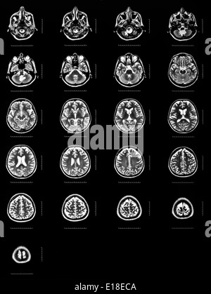 MRI scan of the brain Stock Photo - Alamy