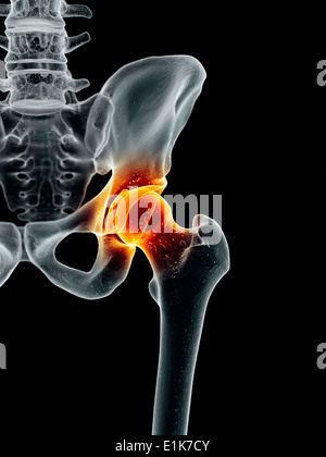 Human hip joint, computer artwork Stock Photo - Alamy
