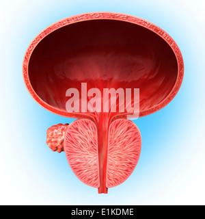 Human prostate gland tumour cut-away computer artwork Stock Photo - Alamy