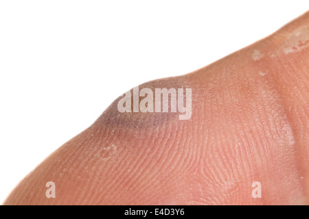 verruca and blister formation after being frozen Stock Photo - Alamy