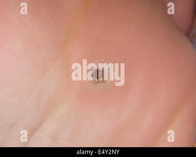 Callus under foot Stock Photo - Alamy