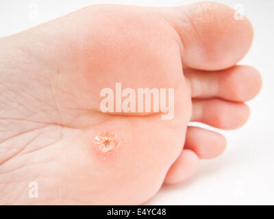 Callus under foot Stock Photo - Alamy