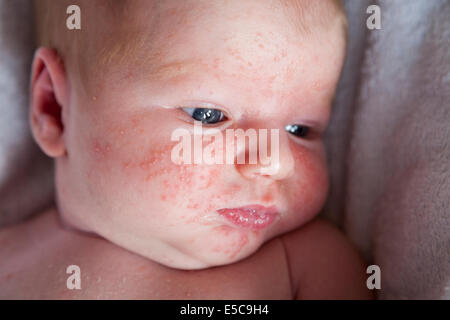 baby acne,Erythema toxicum neonatorum (ETN) is often shortened to ...
