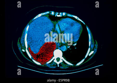 PLEURISY CT SCAN Stock Photo - Alamy