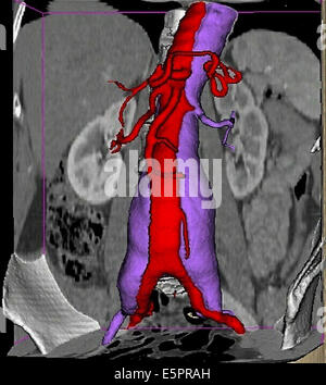 3D Computed Tomographic (CT) reconstruction scan, external view, internal organs and skeleton of ...
