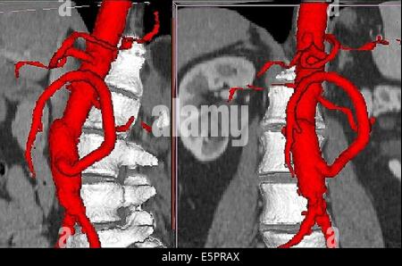 3D Computed Tomographic (CT) reconstruction scan, external view, internal organs and skeleton of ...