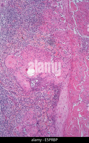 Keratoacanthoma, Skin precancerous lesion, Light microscopy Stock Photo ...
