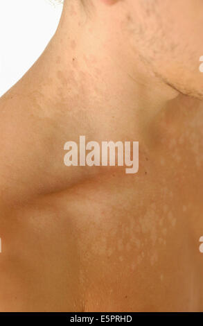 Pityriasis versicolor of the skin Stock Photo: 31078468 - Alamy