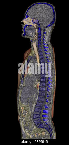 3D Computed Tomographic (CT) reconstruction scan, external view, internal organs and skeleton of ...