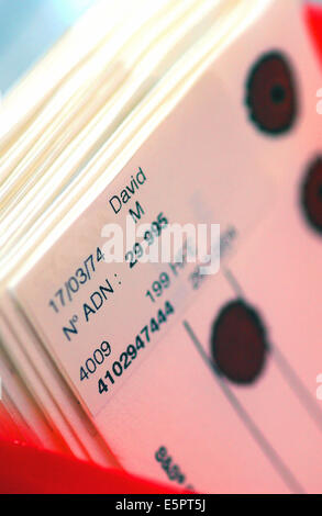 Hemochromatosis, Genetic diagnostic of hemochromatosis obtained with ...