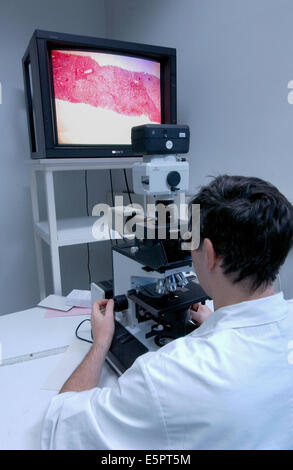 Hemochromatosis, A doctor examinates with an optical microscope ...