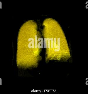 3D Computed Tomographic (CT) reconstruction scan, external view, internal organs and skeleton of ...