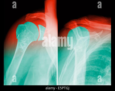 Normal shoulder. X-ray of the healthy left shoulder of a 28 year old ...