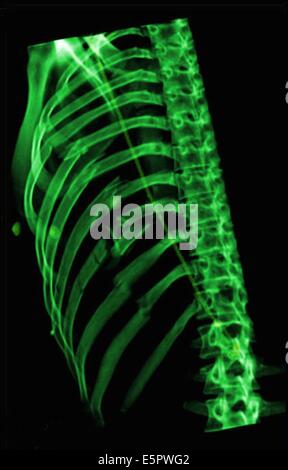 3D Computed Tomography (CT) reconstruction scan of the thoracic cage ...