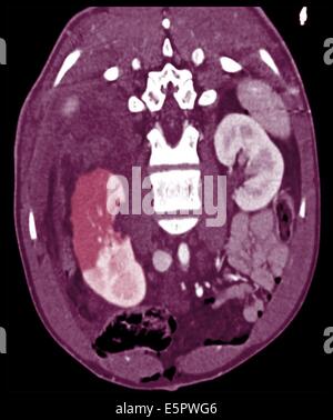 Cross Section of Right Kidney Stock Photo - Alamy