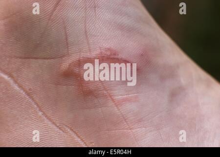 Cutaneous larvae migrans Stock Photo: 261657575 - Alamy