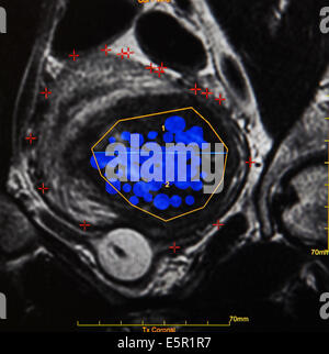 ExAblate® 2000 system with MR guided focused ultrasound uses a combination of high-intensity ...