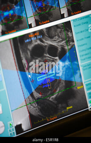 ExAblate® 2000 system with MR guided focused ultrasound uses a ...