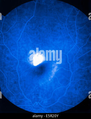 Eye angiography of an Age-Related Macular Degeneration (ARMD Stock ...