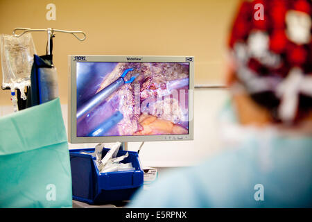 Partial removal of a liver from a living donor by laparoscopy for a ...