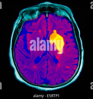 Coloured axial computed tomography (CT) scan of an adult's brain, showing encephalitis in the ...
