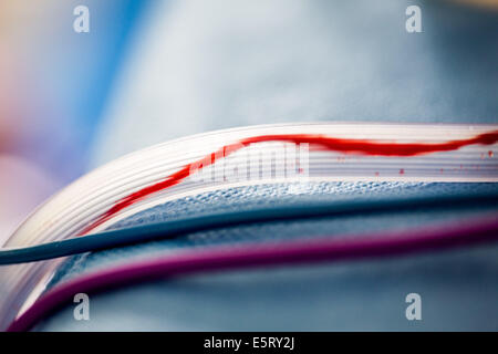Pipe collecting blood during a surgical operation Stock Photo - Alamy