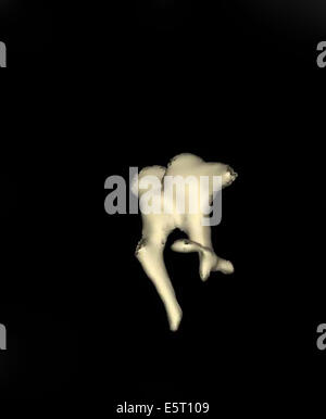 3D reconstruction of the inner ear showing three tiny bones (hammer ...