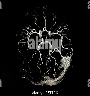 Occipital Lobe AVM Stock Photo - Alamy