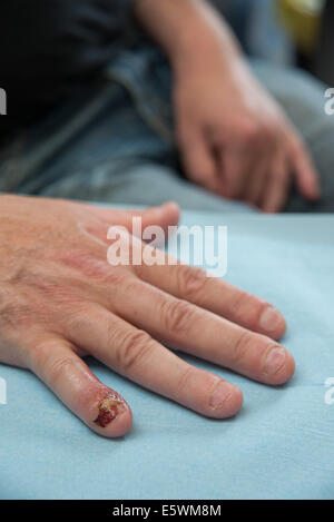 Paronychia infection of the finger. Close-up of the finger of a 7-year ...