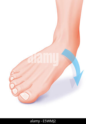 Sprained ankle, drawing Stock Photo - Alamy