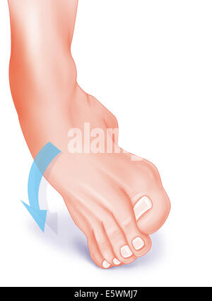 Sprained ankle, drawing Stock Photo - Alamy