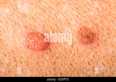 Sores on a human arm show the detail of the healing process by ...