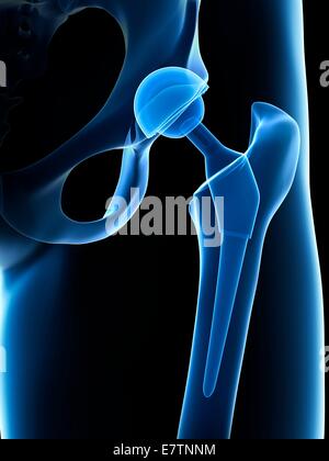 Human hip replacement, computer artwork Stock Photo - Alamy