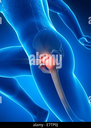 Painful human hip joints, computer artwork Stock Photo - Alamy