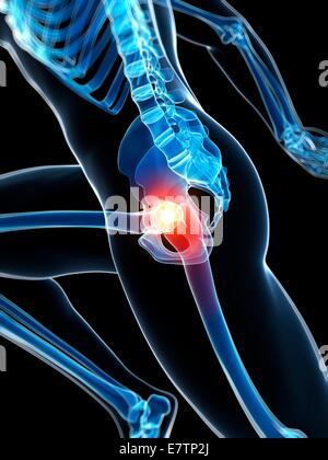 Human hip joint computer artwork Stock Photo - Alamy