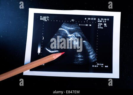 Sonography pregnancy picture of embryo with baby booties Stock Photo ...