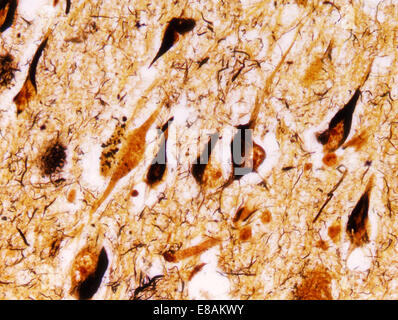 Alzheimer's Disease, Neurofibrillary Tangles Stock Photo - Alamy