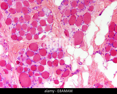 Muscular dystrophy. Light micrograph of a section through muscle tissue ...