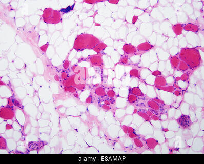Muscular dystrophy. Light micrograph of a section through muscle tissue ...