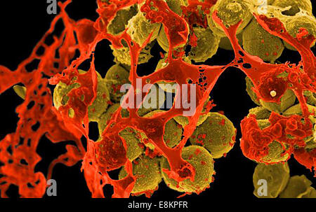 methicillin resistant staph aureus (MRSA) skin infection in a 26 year ...