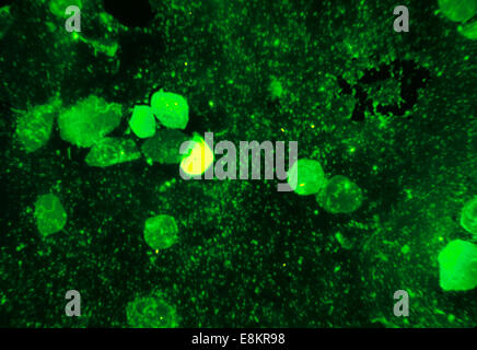Here we see Mycobacterium tuberculosis in sputum smear is stained using fluorescent acid-fast ...