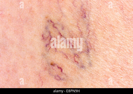 Leg with varicose veins close up Standing person with varicose veins in ...
