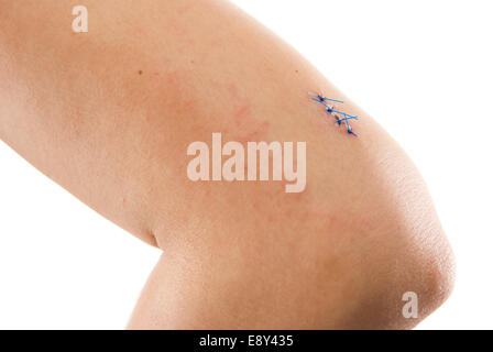 stitched up injury Stock Photo - Alamy