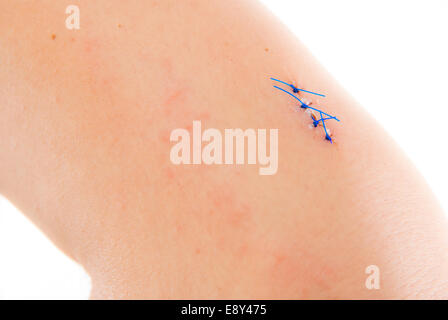 stitched up injury Stock Photo - Alamy