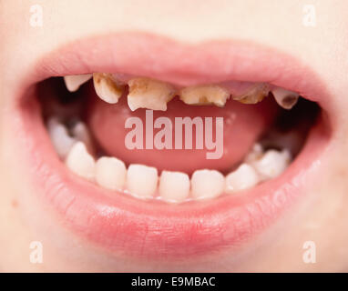 Close up of unhealthy baby teeth. Girl open mouth showing caries teeth ...