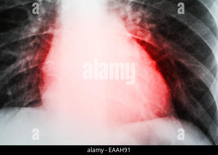 x-ray red heart of human (heart disease Stock Photo - Alamy