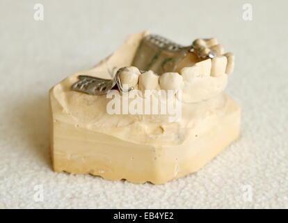 Dental metal framework for partial denture on cast model Stock Photo ...