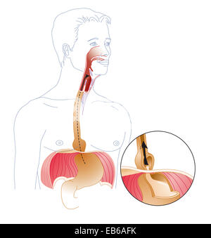 HIATAL HERNIA, DRAWING Stock Photo - Alamy