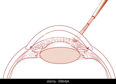 CATARACT SURGERY, DRAWING Stock Photo - Alamy